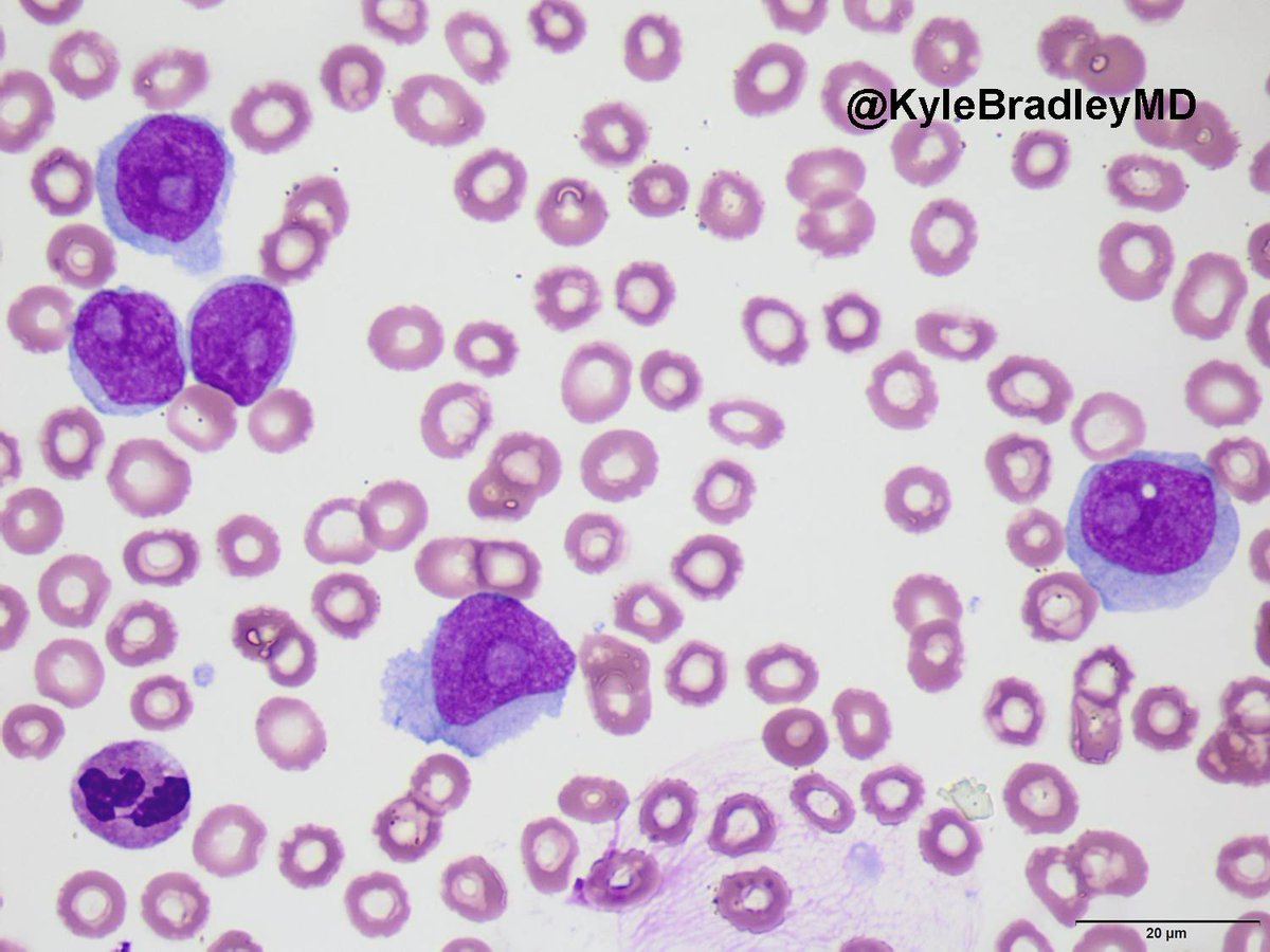 Prolymphocyte