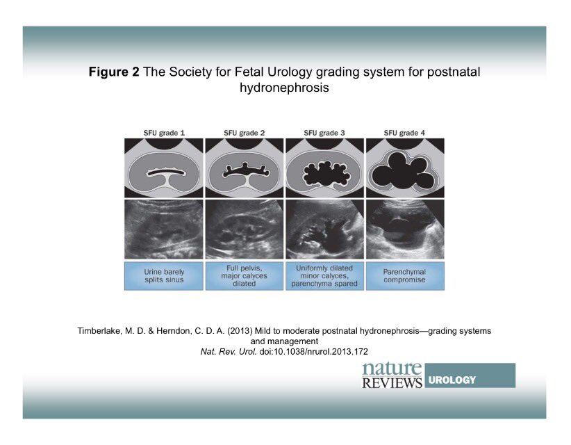 Hydronephrosis Grading