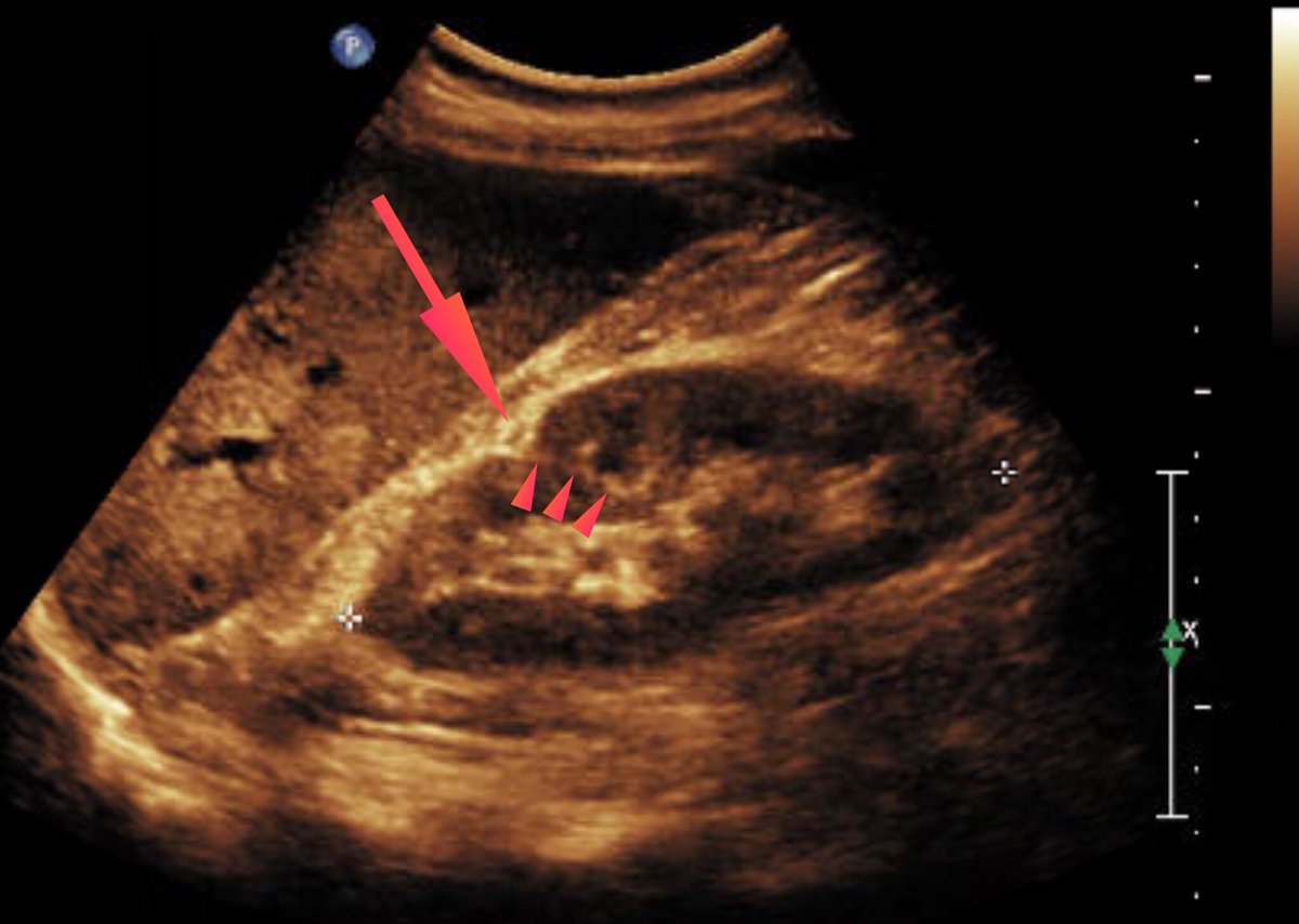 Junctional Parenchymal Defect