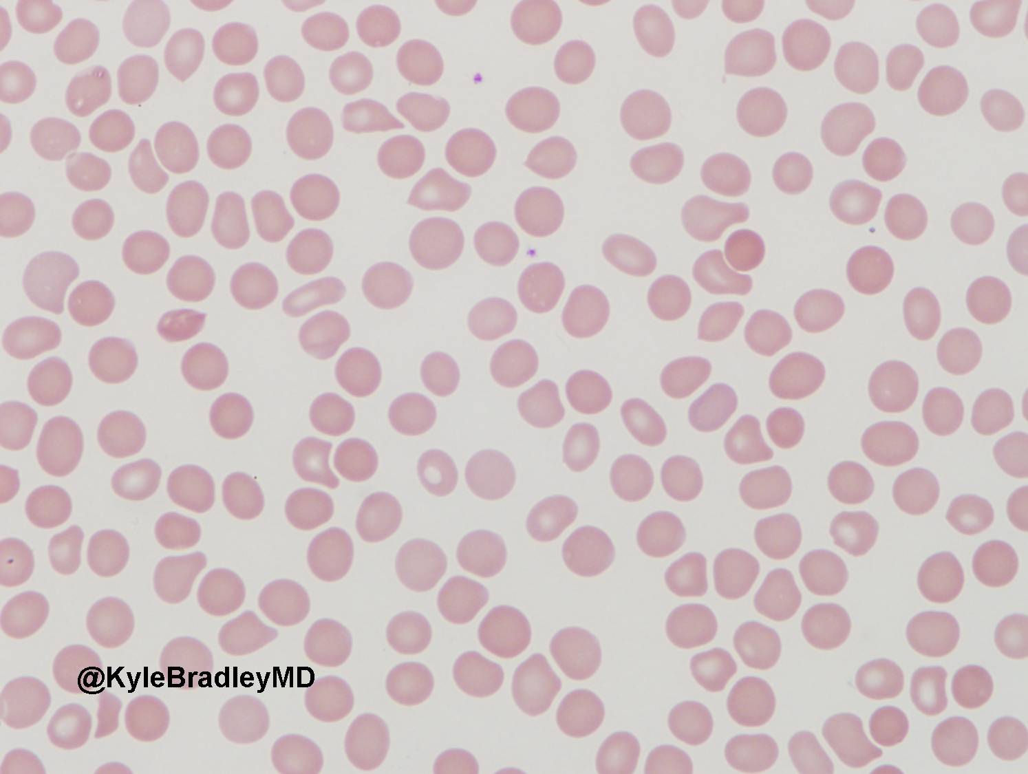 Wiskott Aldrich Syndrome