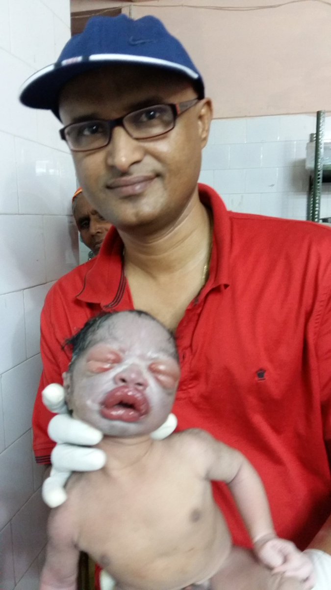 Face Presentation Birth