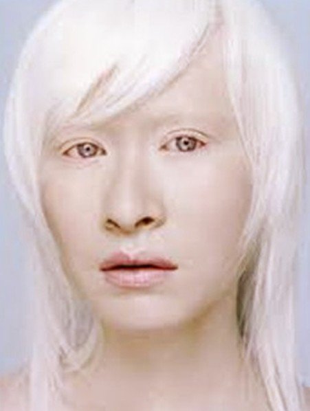 Albinism In Asia