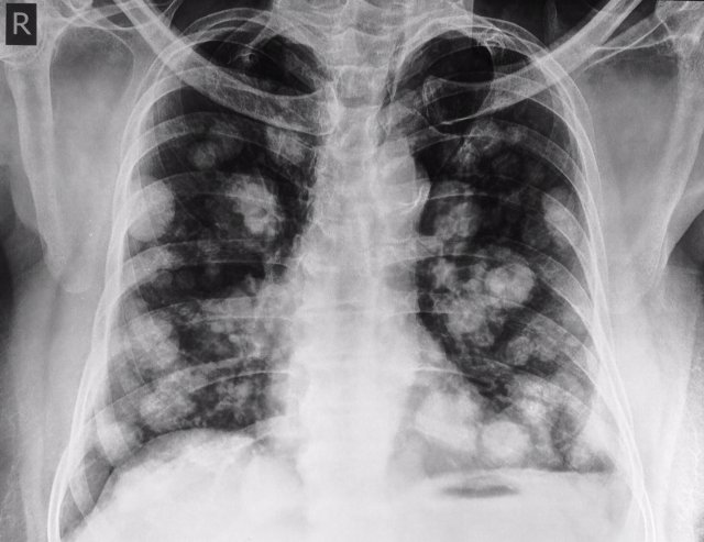 Bloc d´un Metge de Família: El signe radiogràfic: "bales de canó"