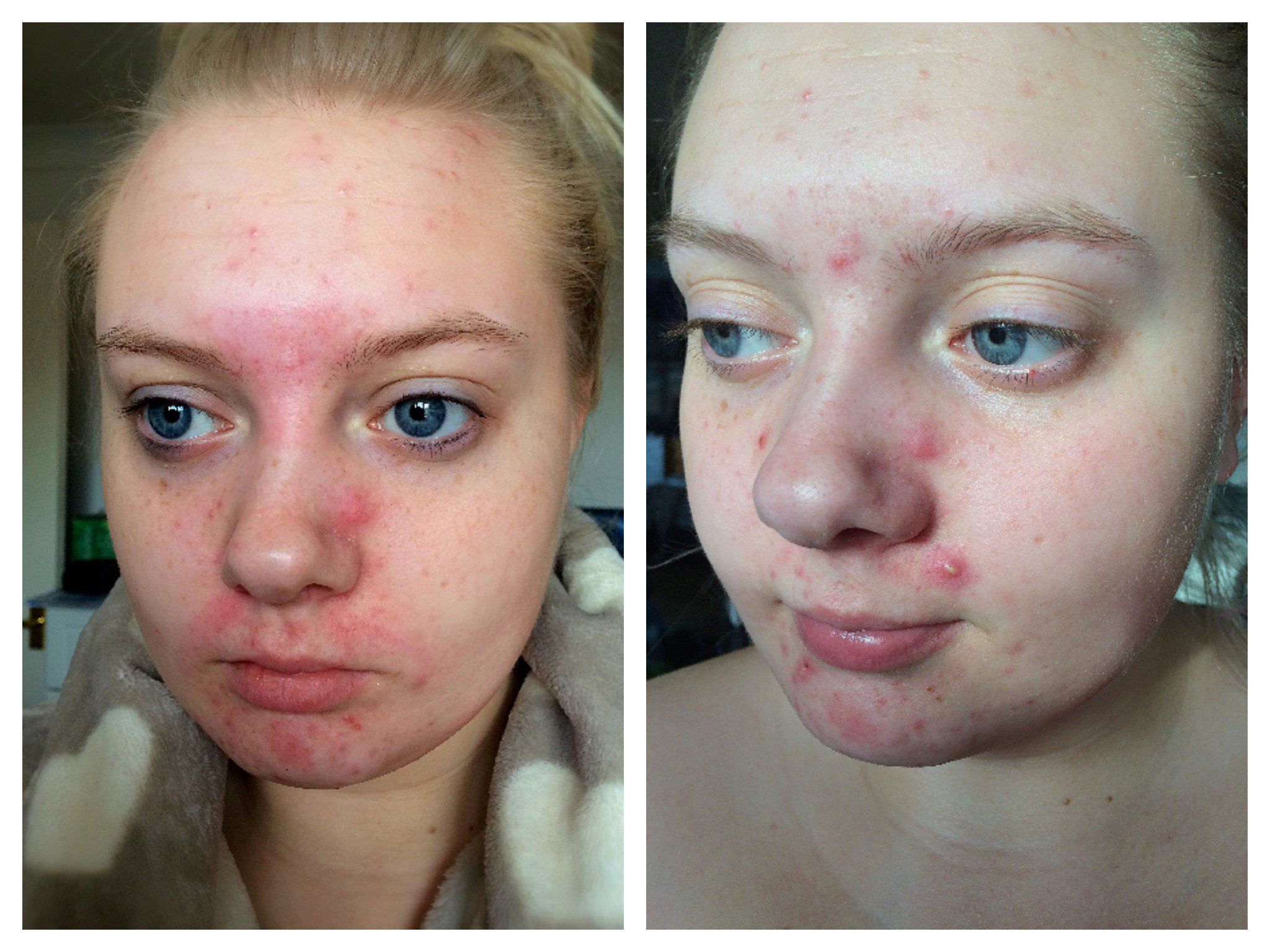 Acne Before And After Proactiv