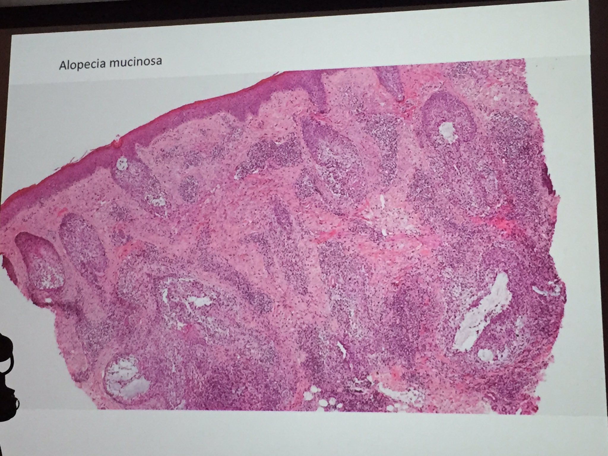 Follicular Mucinosis Histology