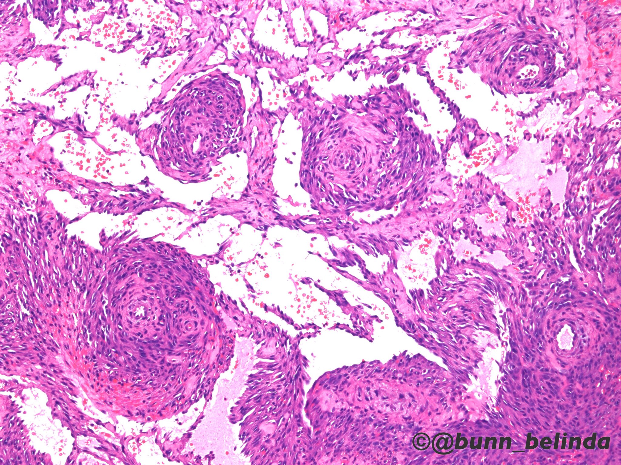 Kaposi Sarcoma Histology