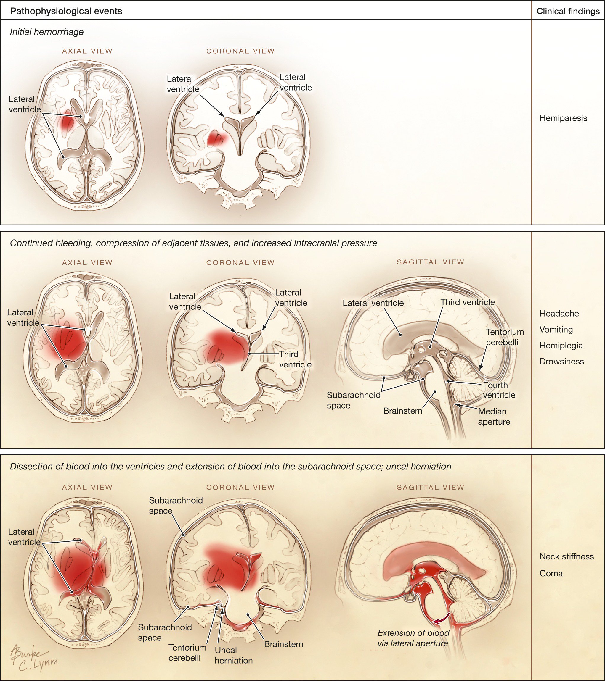 Intracerebral Hemorrhage Pathophysiology
