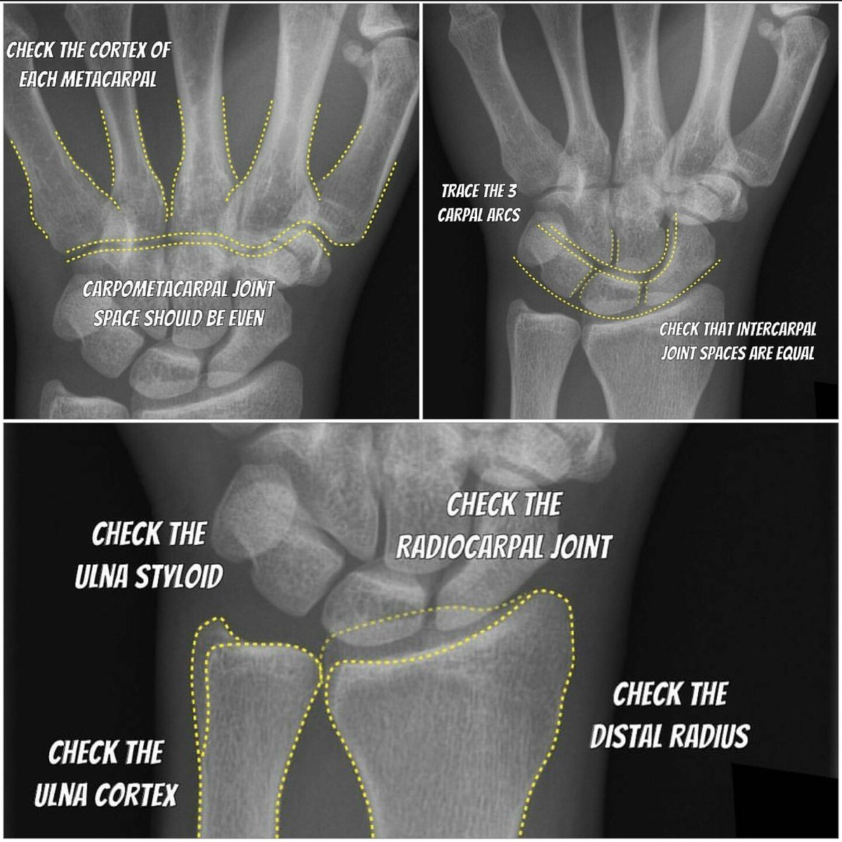 ajedrez Mierda Tren radiografia muñeca normal maquinilla de afeitar ...
