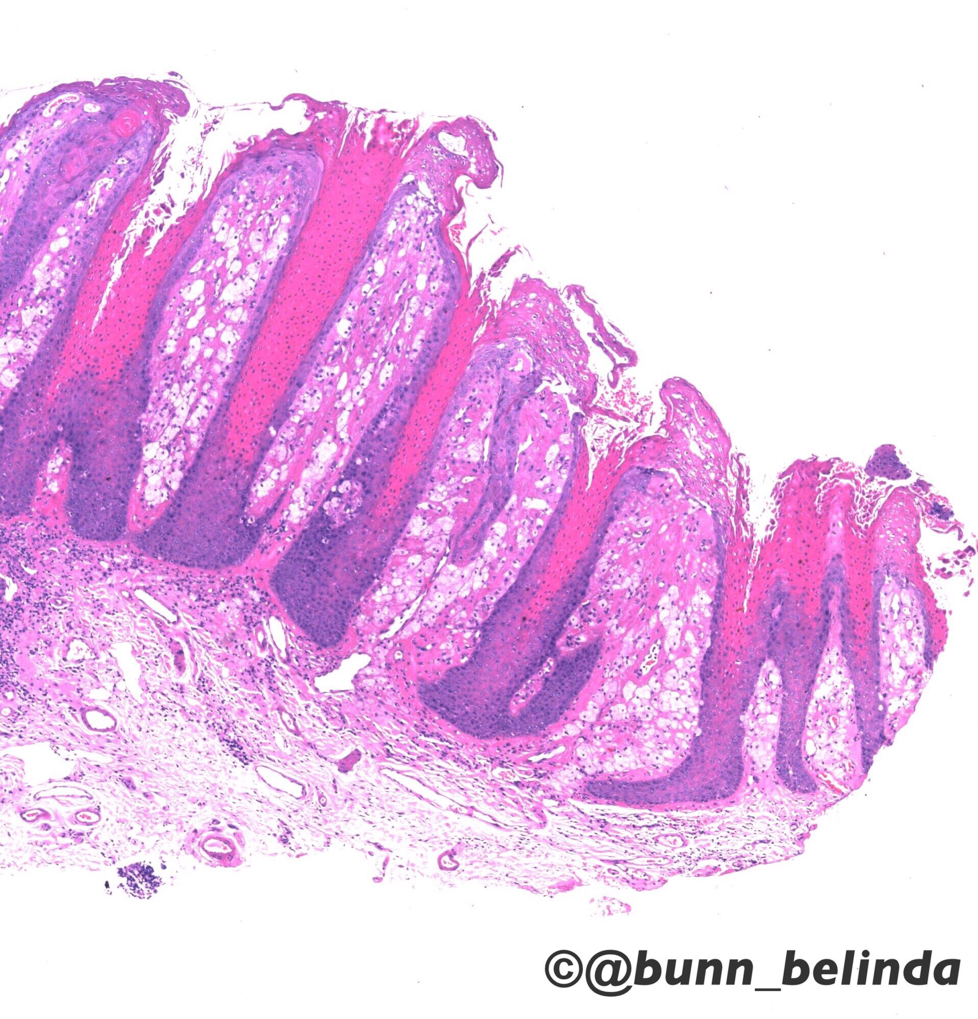 Verruciform Xanthoma Histology