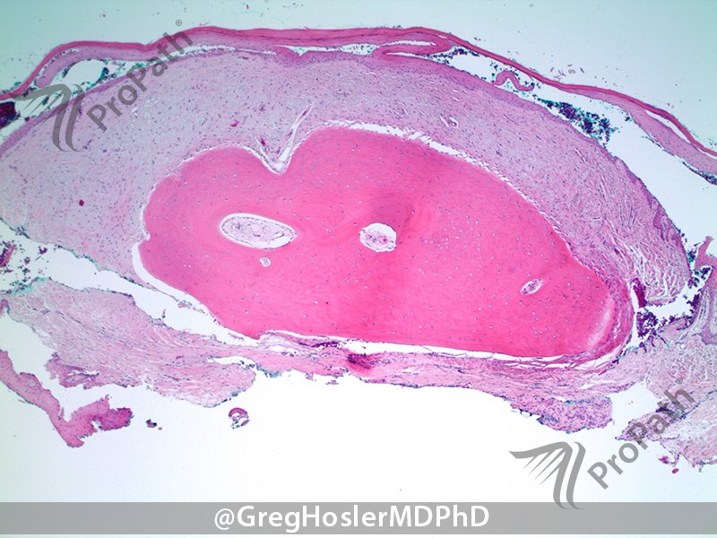 Torus Mandibularis Histology Mandibular Tori: Things To Know 1311