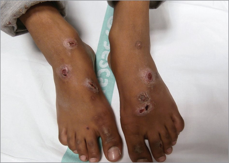 Cutaneous Diphtheria