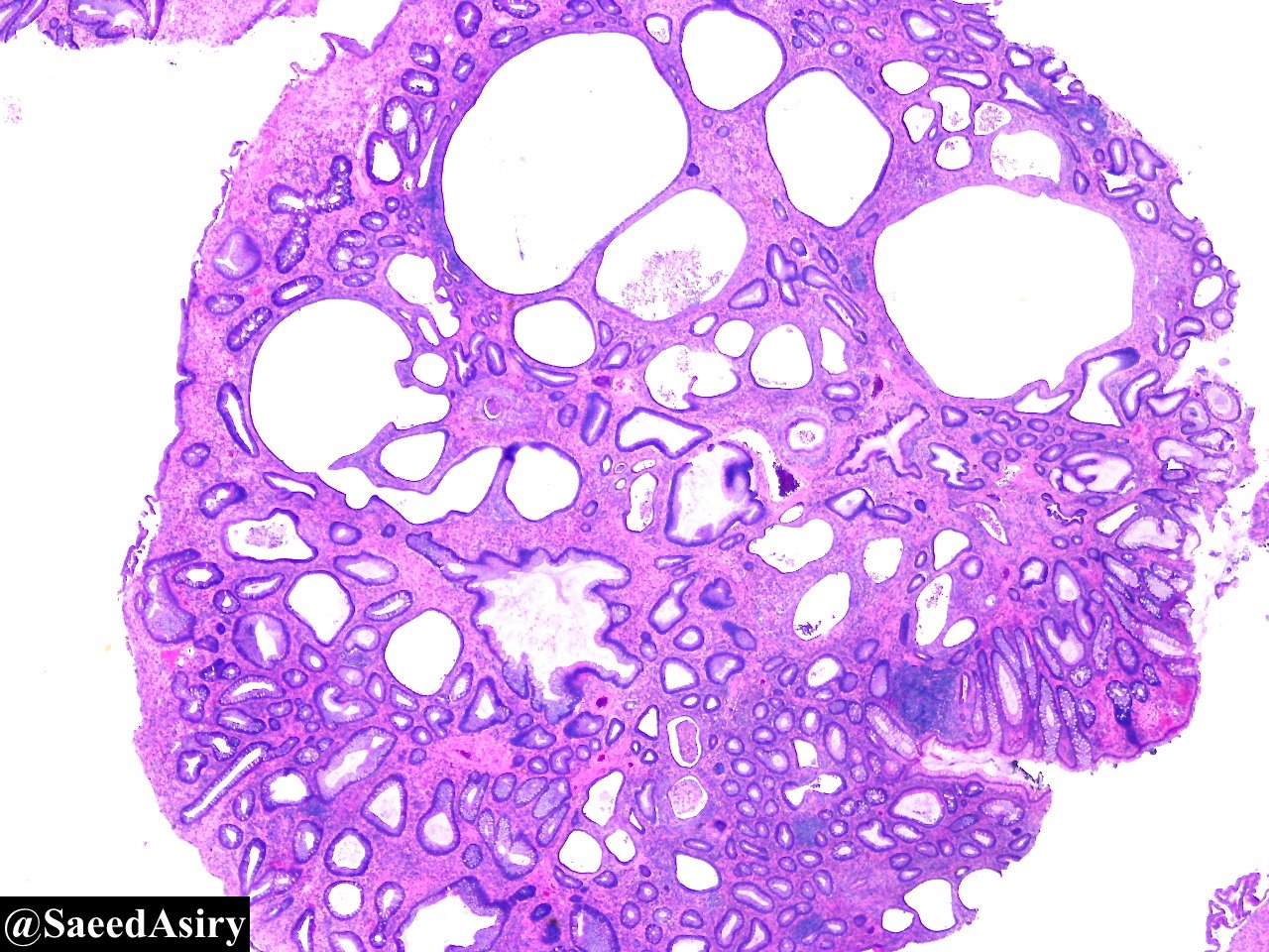Juvenile Polyposis Pathology Outline Pathology Outlines Hyperplastic