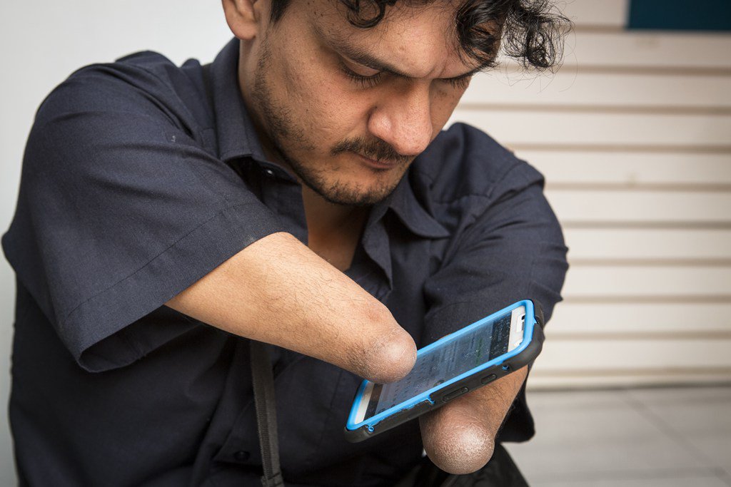With no hands or feet, this man in Mexico becomes a bio-medical ...