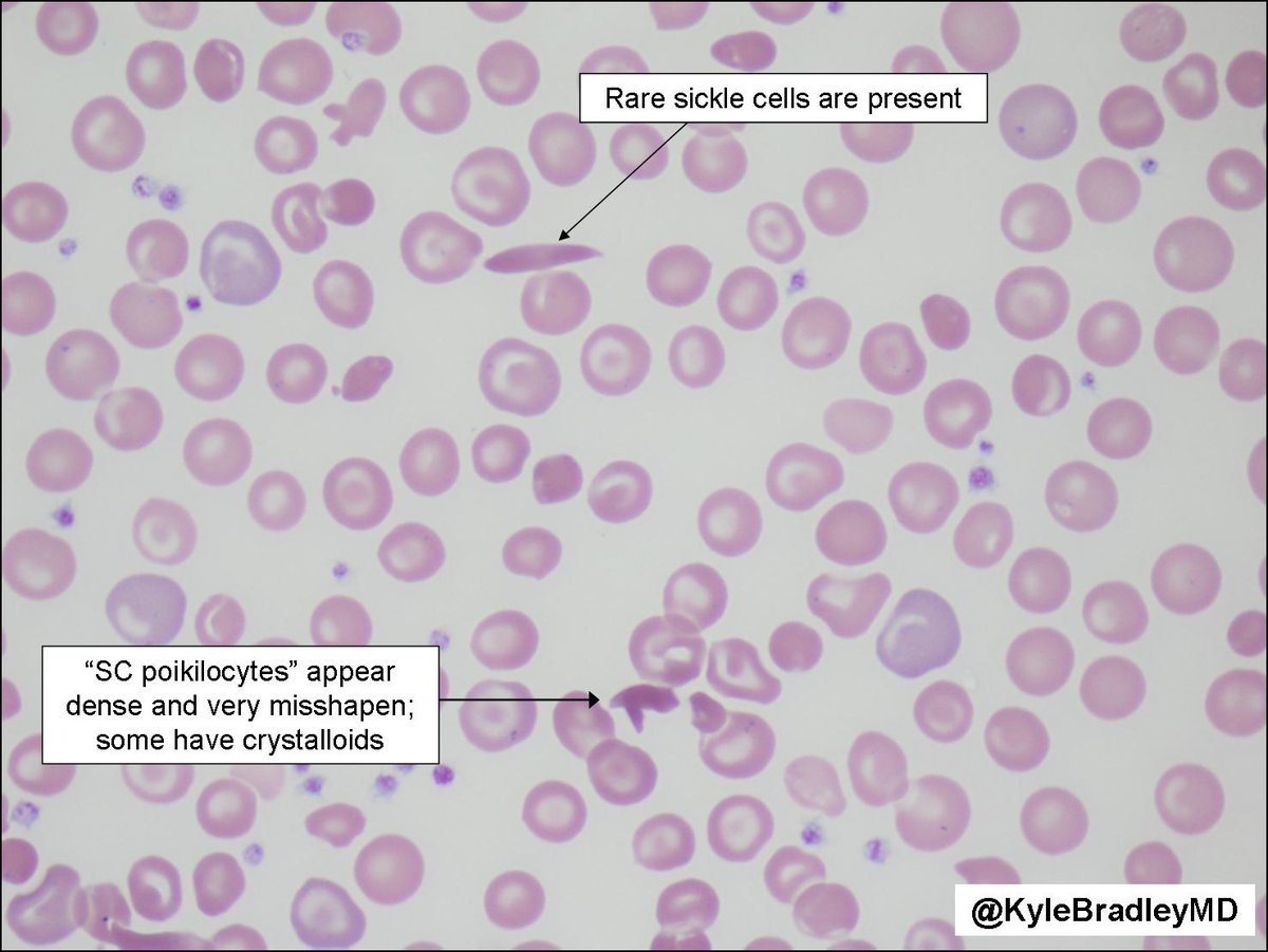 Hemoglobin Sc Disease Blood Smear