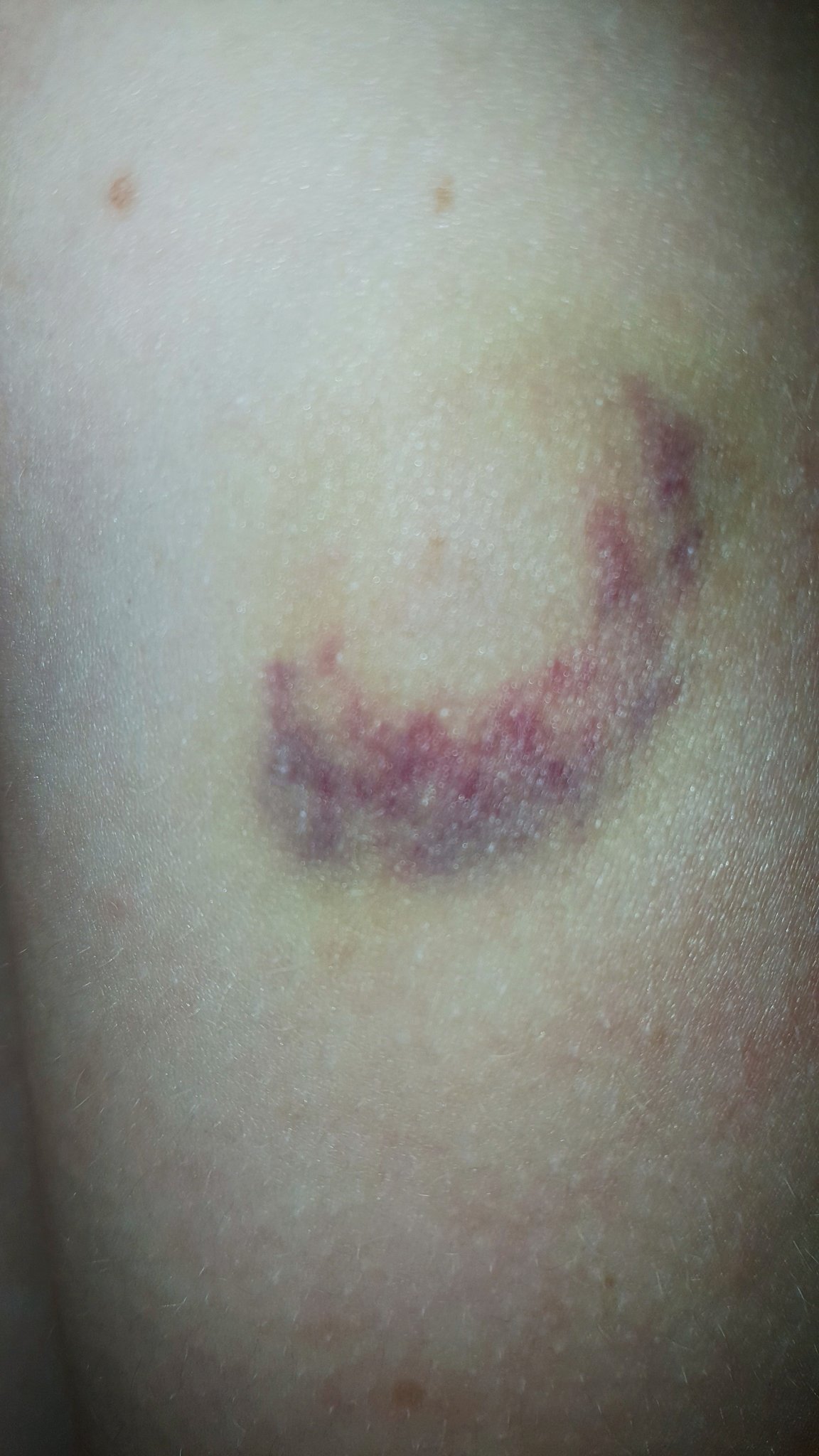 Ring Shaped Bruises