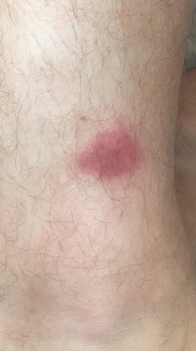 Itchy Bug Bites That Look Like Hickeys