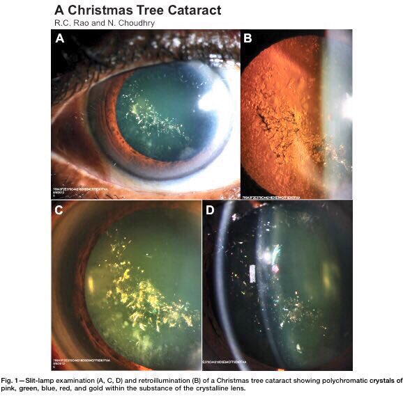 Christmas Tree Cataract