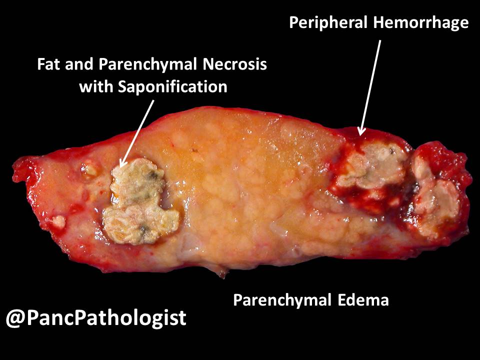 Acute Pancreatitis Gross