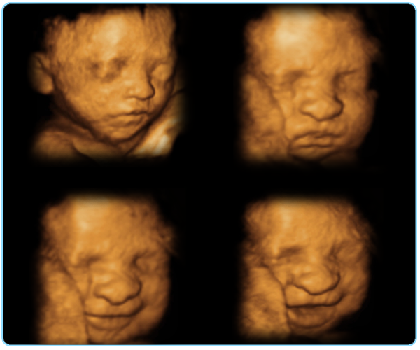 Ecografías 3D y 4D: la mágica ventana para ver en tu interior ...