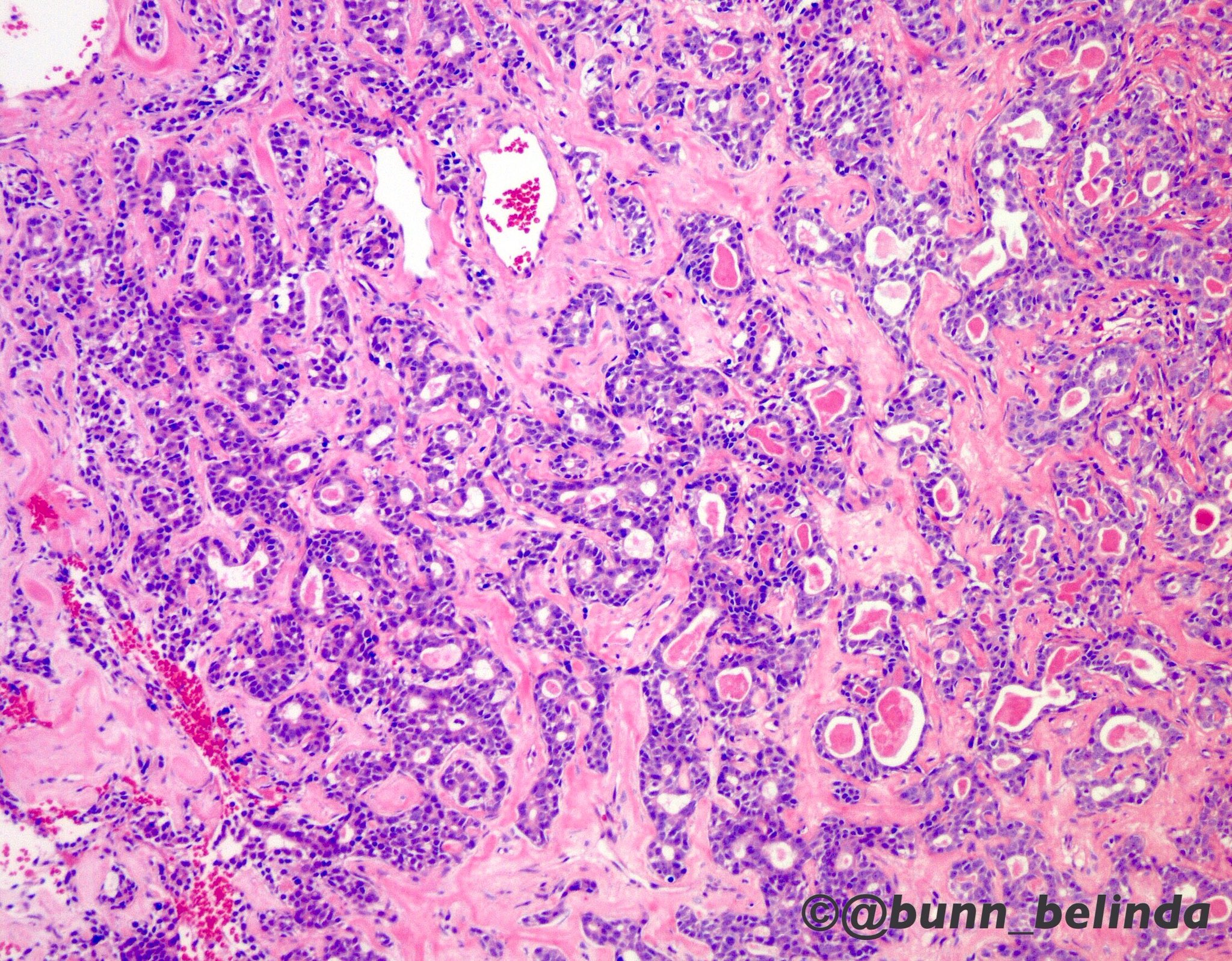 Pleomorphic Adenoma Pathology