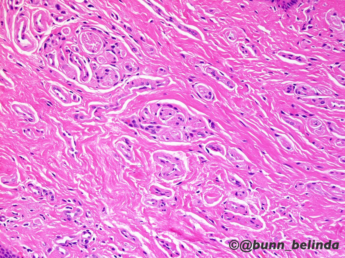 Traumatic Neuroma Pathology Outlines