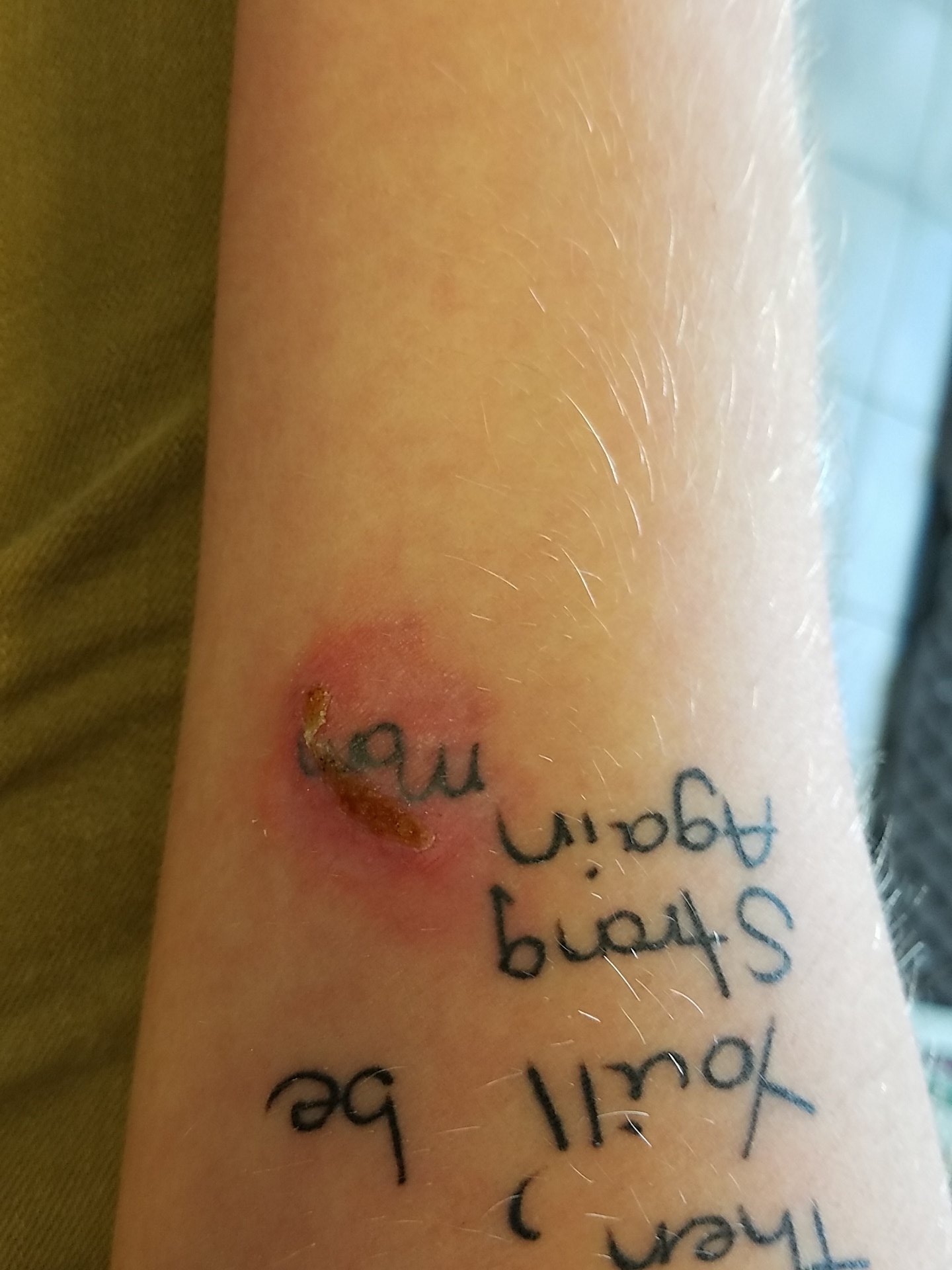 Burned Off Tattoos