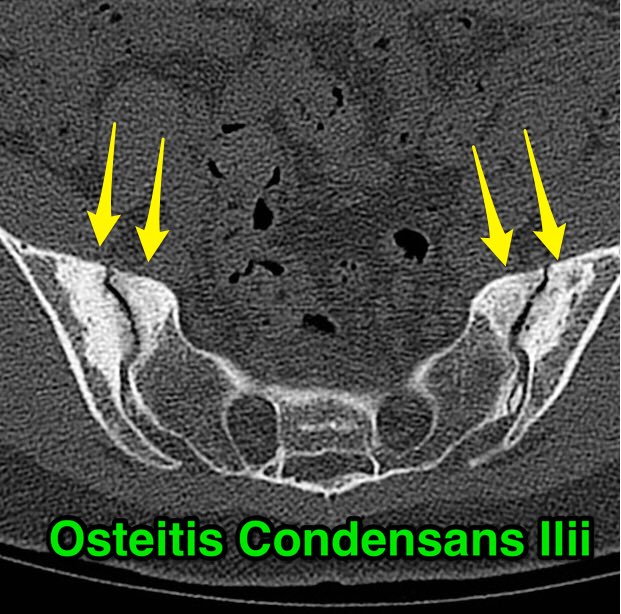 Osteitis Condensans Ilii