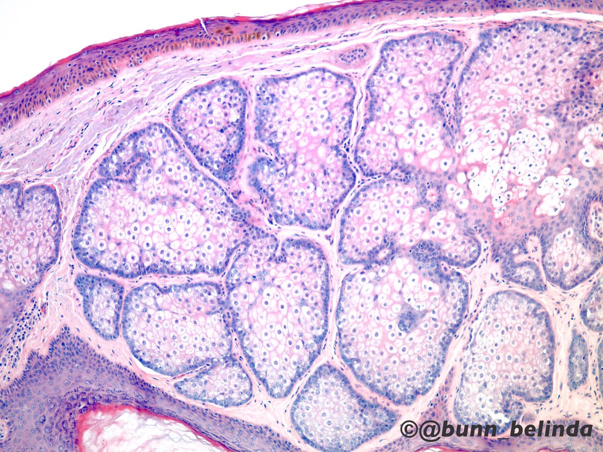 Sebaceous Hyperplasia Histology