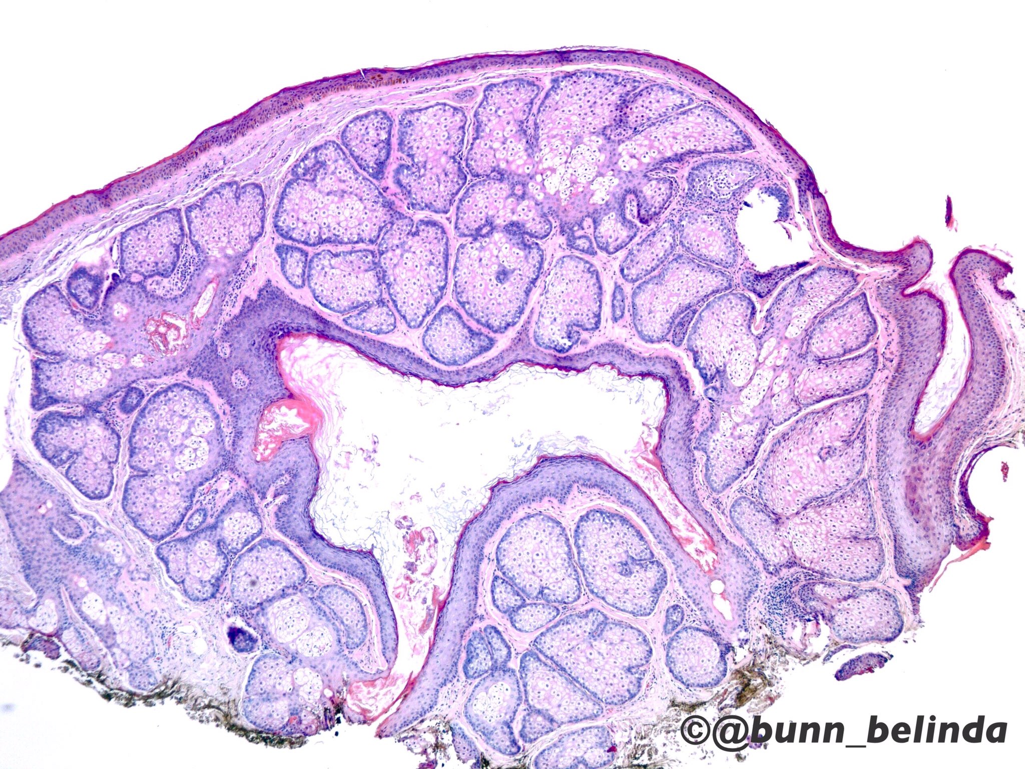 Sebaceous Hyperplasia Histology