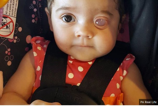 Human Born With One Eye