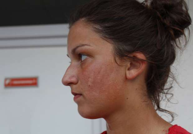 Slap Handprint On Face