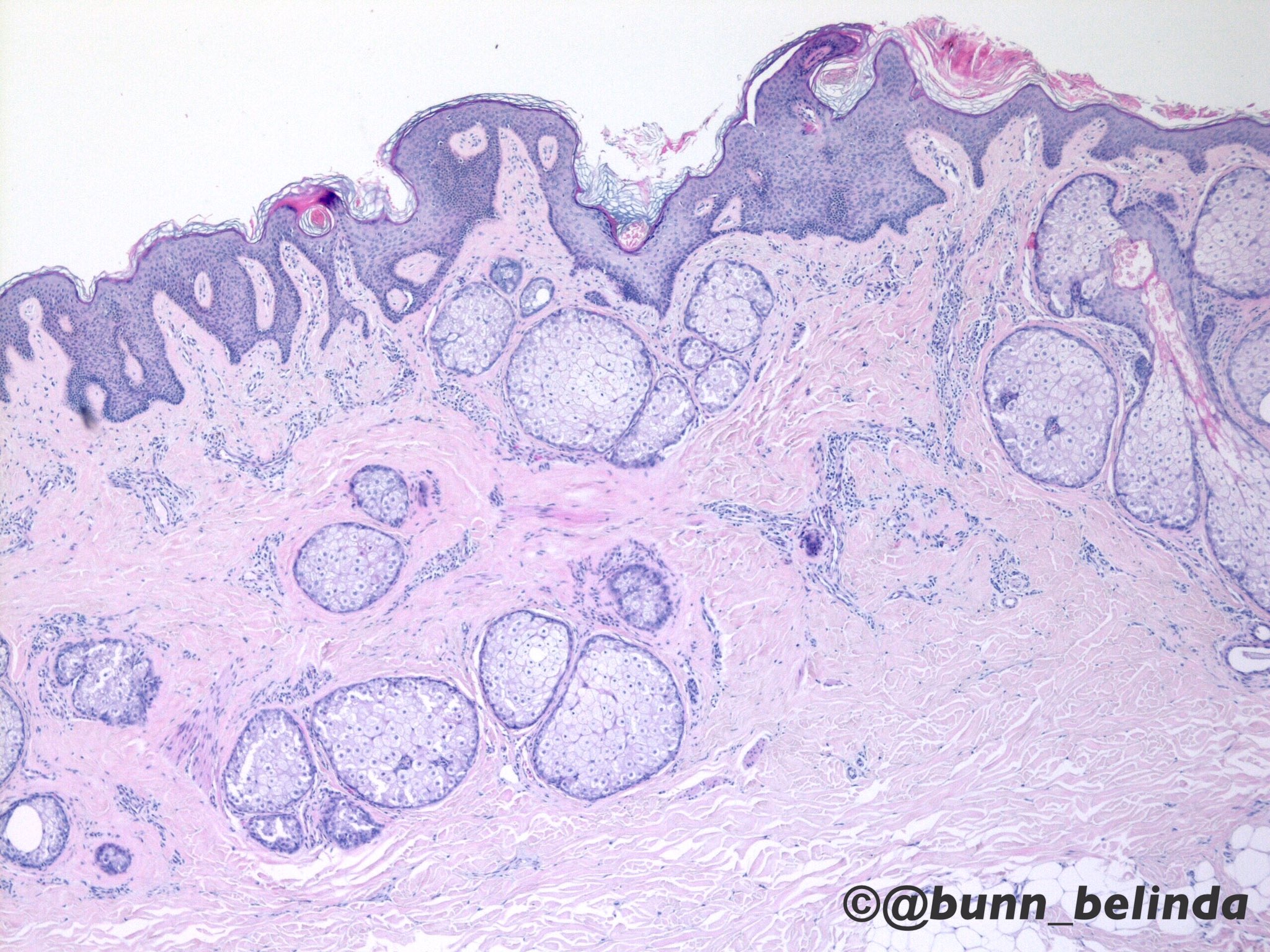 Epidermal Nevus Histology Pathology Outlines Nevus Sebaceus Of