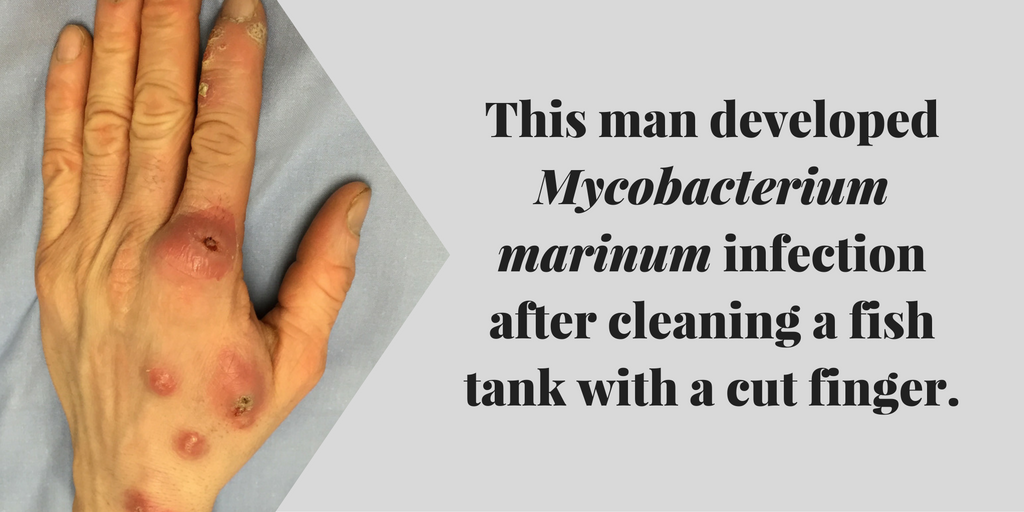Mycobacterium Marinum Nontuberculous Mycobacterial Skin Infections: