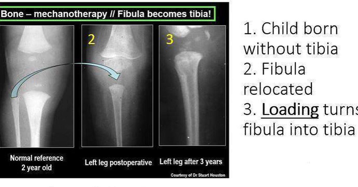 Born Without Fibula