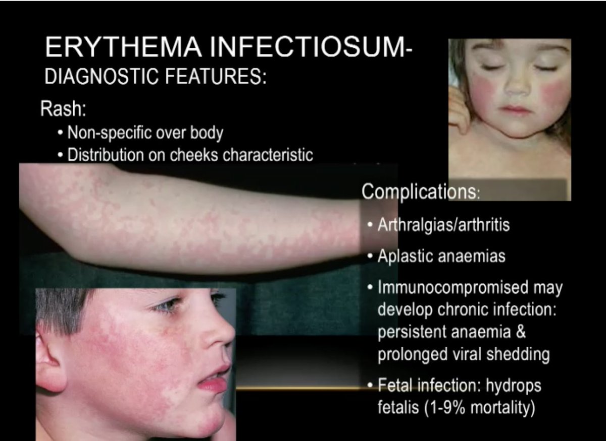 Erythema Infectiosum