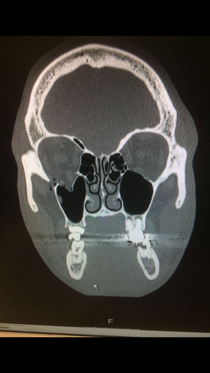 Fractured Eye Socket