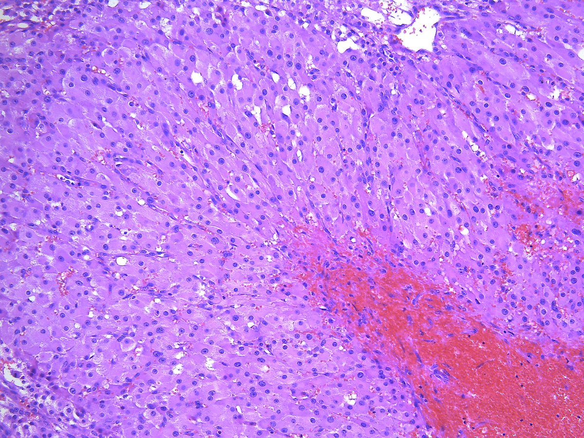 Corpus Hemorrhagicum Histology