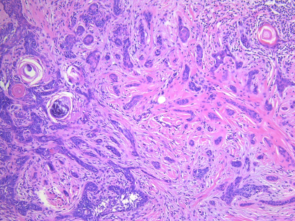 Morpheaform Basal Cell Carcinoma Histology