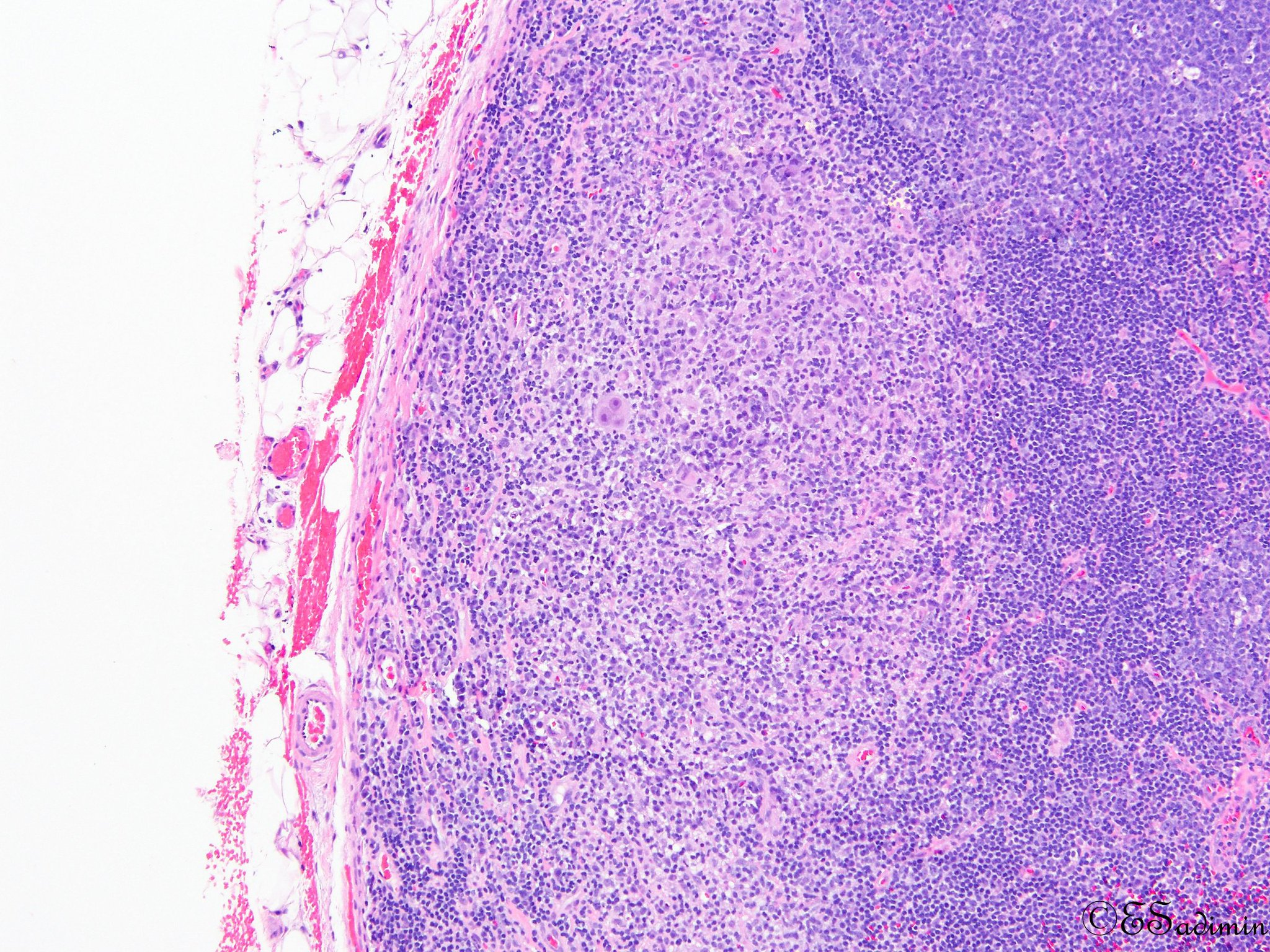 Metastatic Melanoma Histology