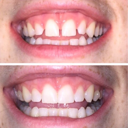 Invisalign Gap In Front Teeth