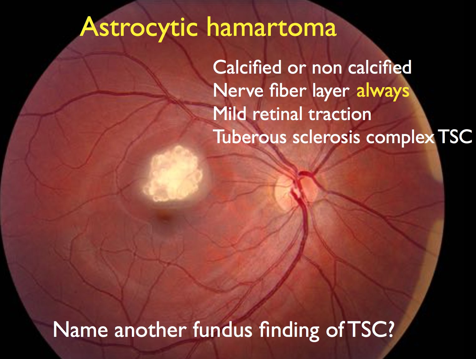 Tuberous Sclerosis Eye
