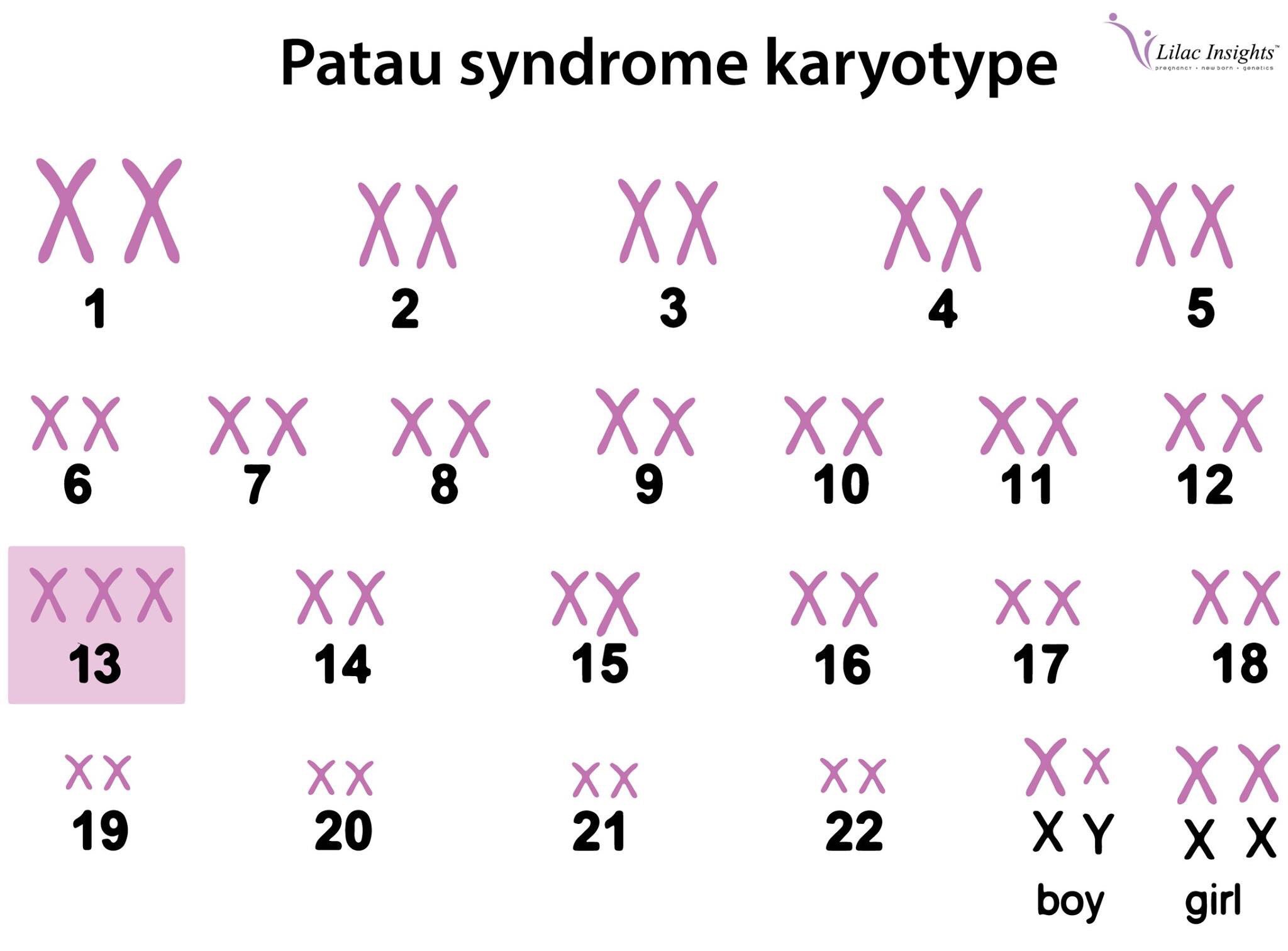 Patau Syndrome For Testing