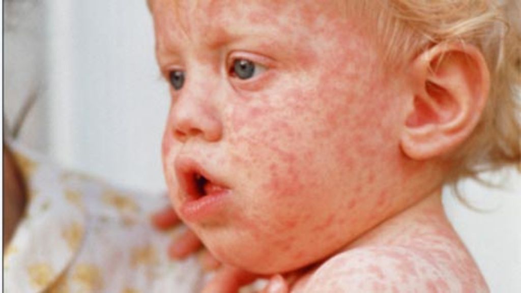 Measles Rash Face