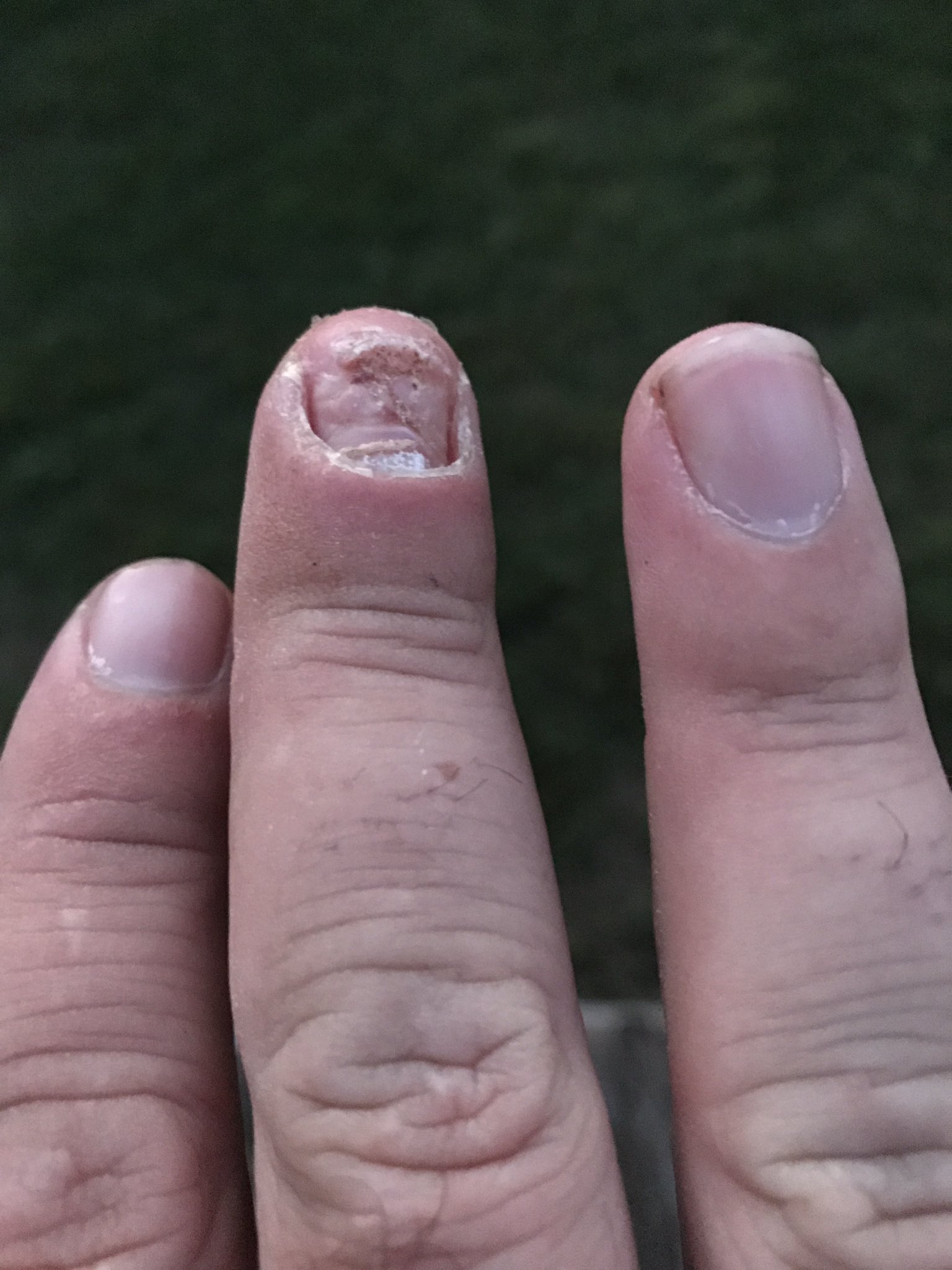 Smashed Fingernail