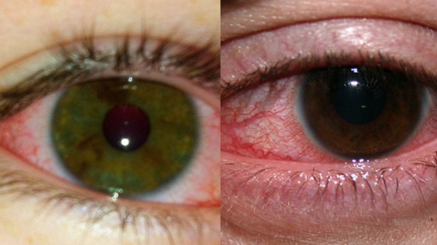 Limbic Sparing Conjunctivitis Diagnosis, Management, And Treatment Of