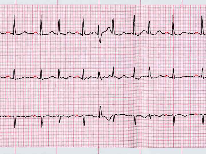 Atrial Fibrillation With Slow Ventricular Response