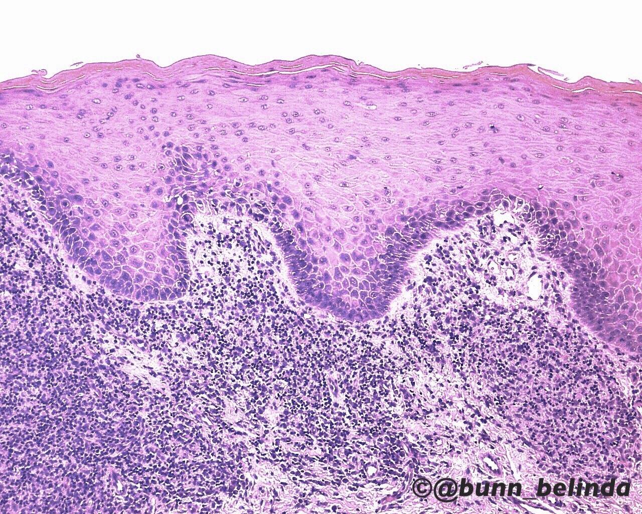 Oral Candidiasis Histology