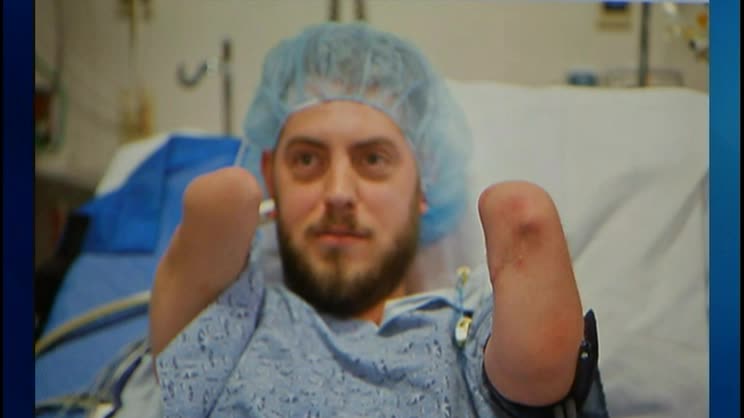 Retired marine sgt. john peck gets arm transplant, is excited to hold ... Retired marine sgt. john peck gets arm transplant, is excited to hold ...