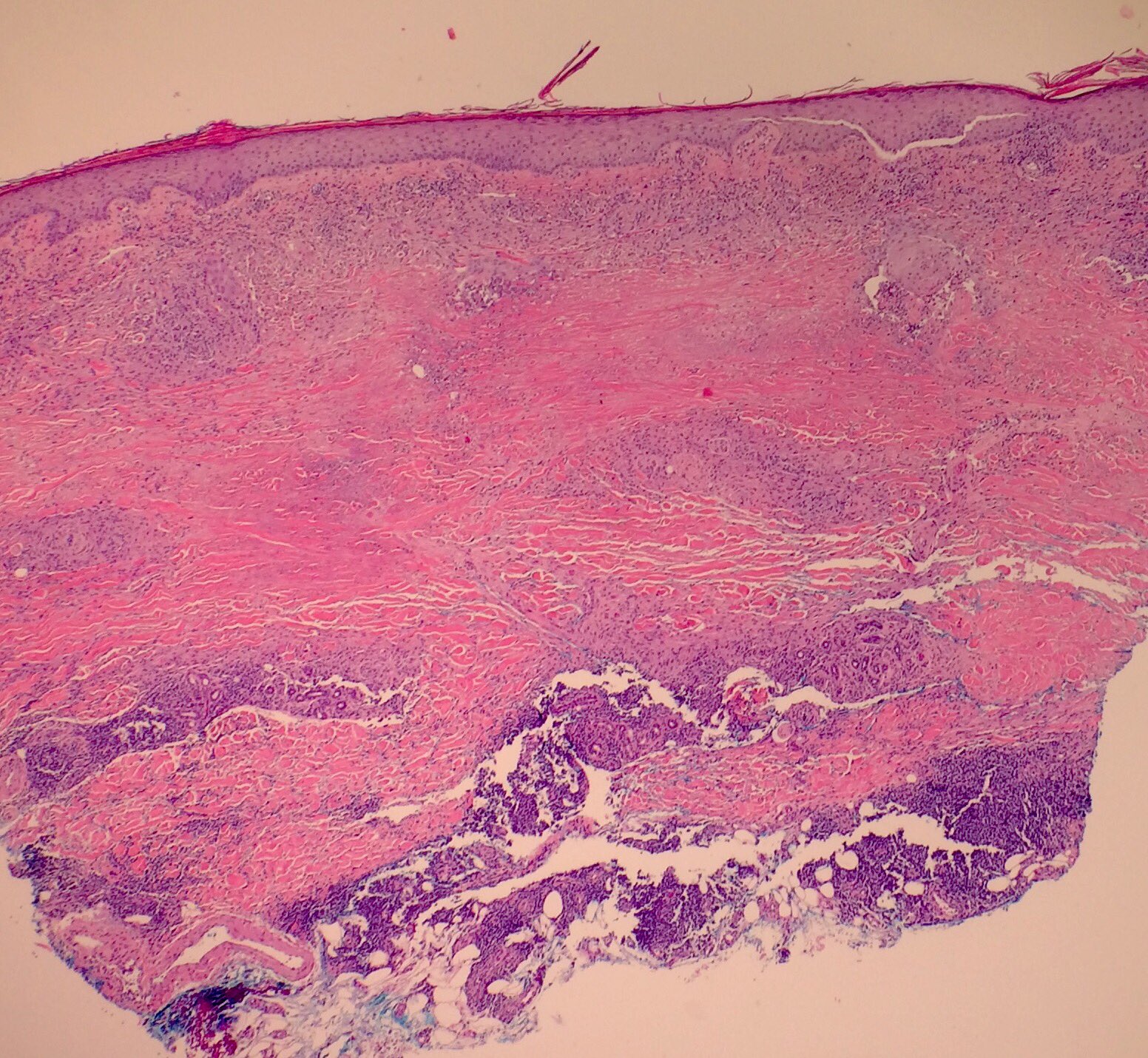 Necrobiosis Lipoidica Diabeticorum Histology
