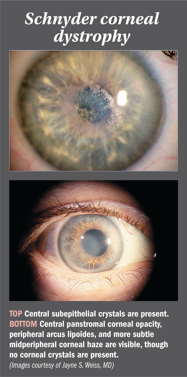 Schnyder Corneal Dystrophy Genetic Analysis Of 14 Families With